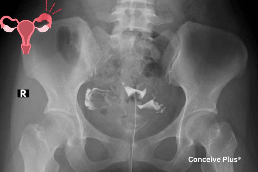 Hysterosalpingogram HSG Cost | Conceive Plus®